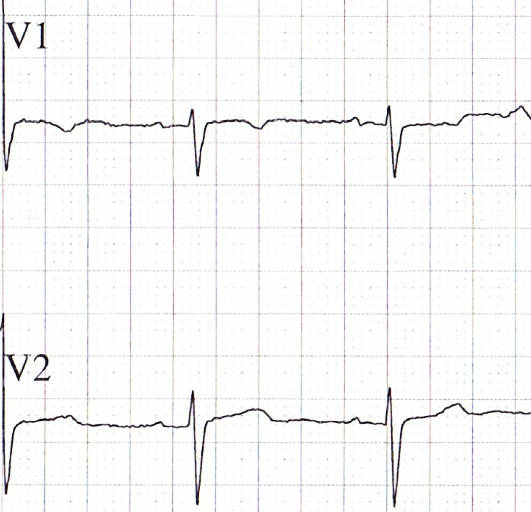 Doc Cottle's Desk: How to cure incomplete RBBB.