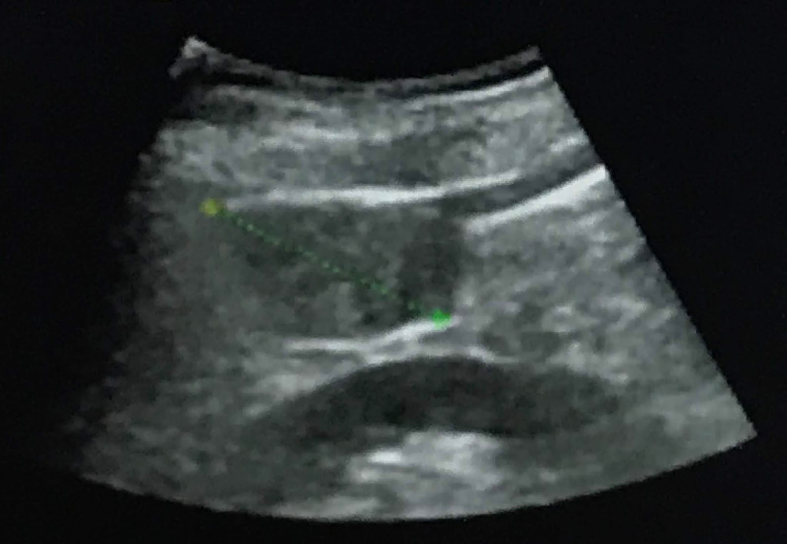 VIETNAMESE MEDIC ULTRASOUND: CASE 520: LIVER TUMOR WITH LOW AFP, Dr ...