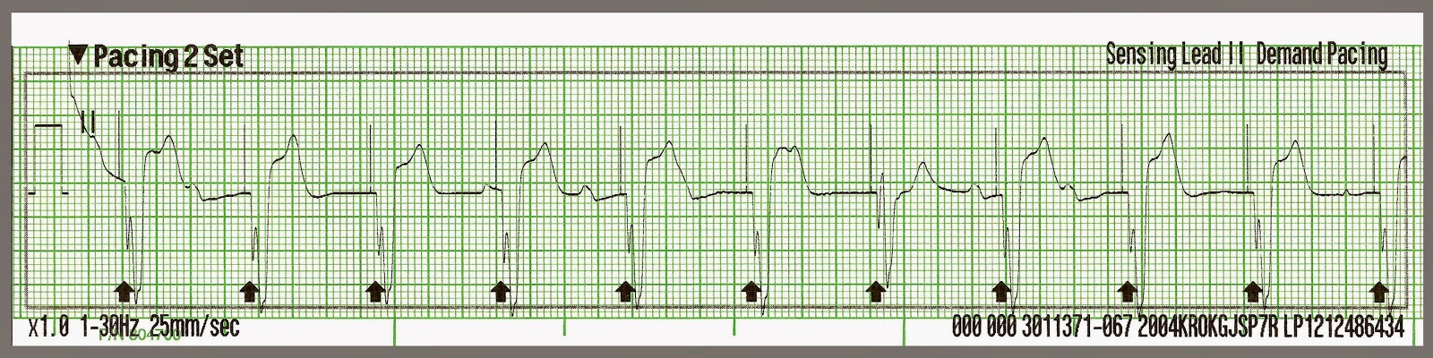 Practice EKG Strips 417