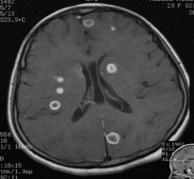MRI MEDIC CASE STUDIES COLLECTION: BRAIN AND SPINAL CORD LESIONS ...