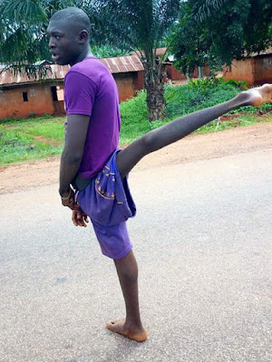 Photo of a young man with unusual severe leg deformity in Kogi State