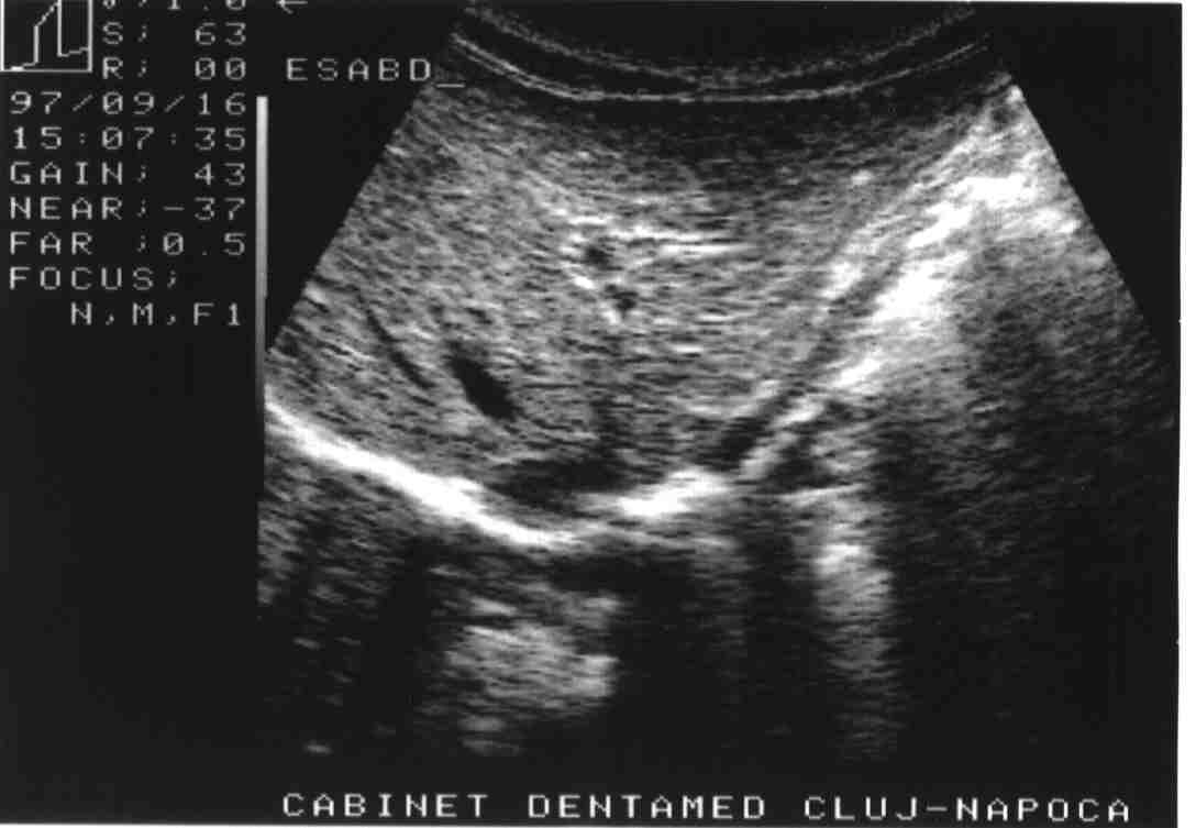 imagini ecografie esofag | Terapii naturiste si Tratamente