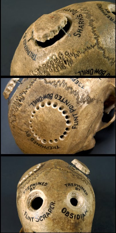 TYWKIWDBI ("Tai-Wiki-Widbee"): A comparison of trephination techniques