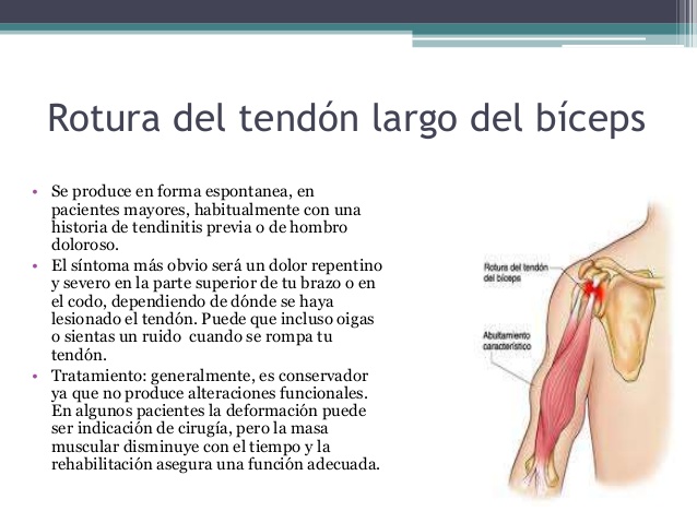 FMC BORMUJOS: SIGNO DE POPEYE: ROTURA TENDON LARGO BICEPS.