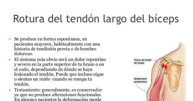 FMC BORMUJOS: SIGNO DE POPEYE: ROTURA TENDON LARGO BICEPS.