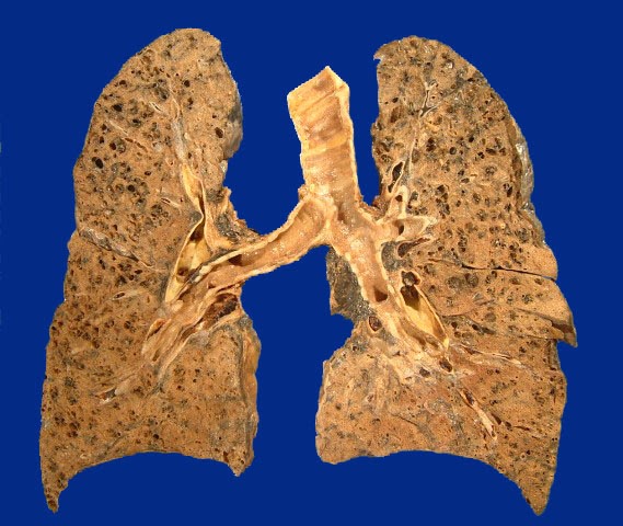 PATOLOGIA: PATOLOGÍA PULMONAR (ENFERMEDAD PULMONAR OBSTRUCTIVA CRÓNICA)