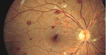 Roth’s Spots Pictures, Definition, Symptoms, Causes, Treatment - Health ...