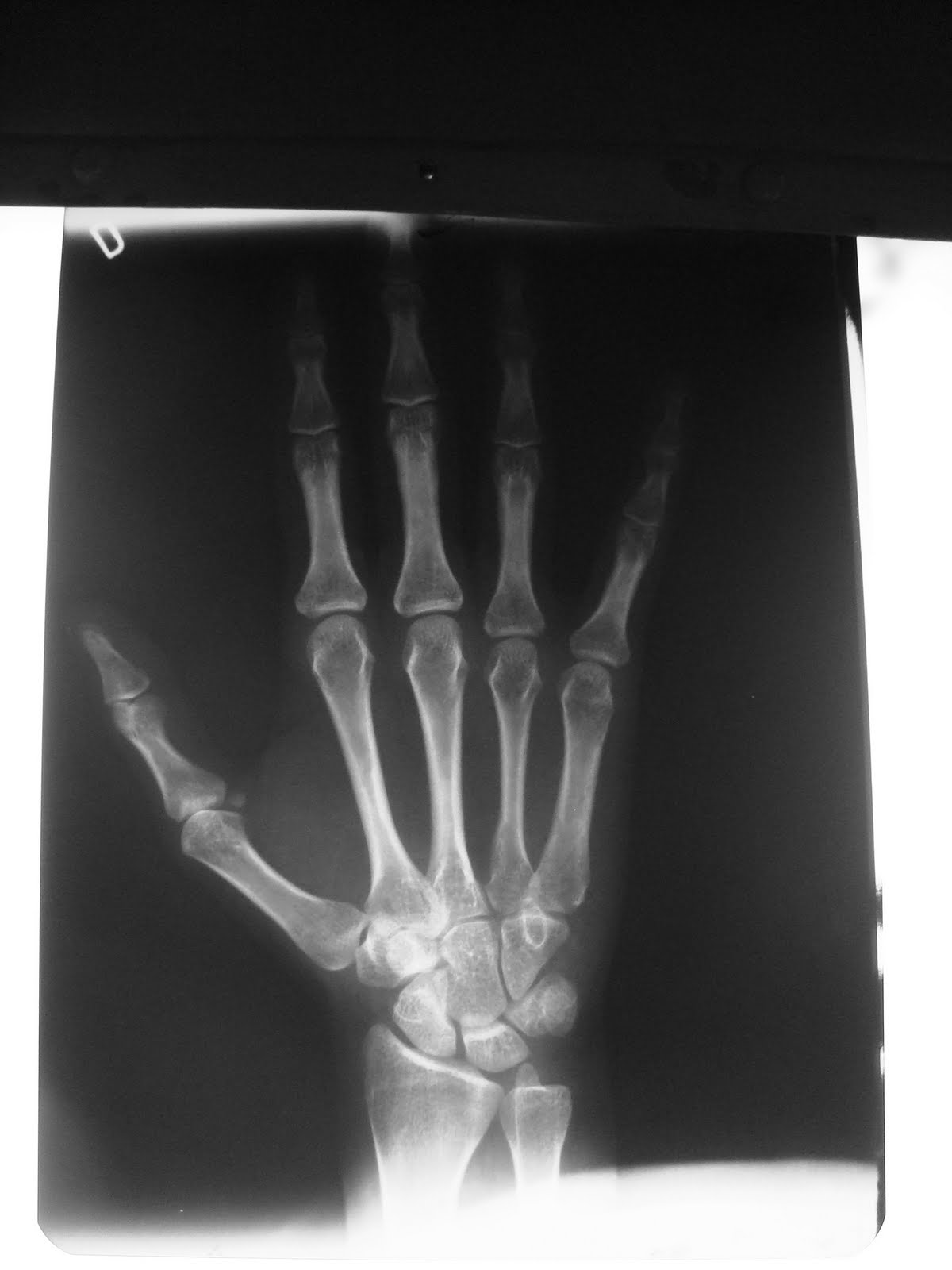 RADIOLOGIA 1: Mano- proyección P.A- Nota: A.P