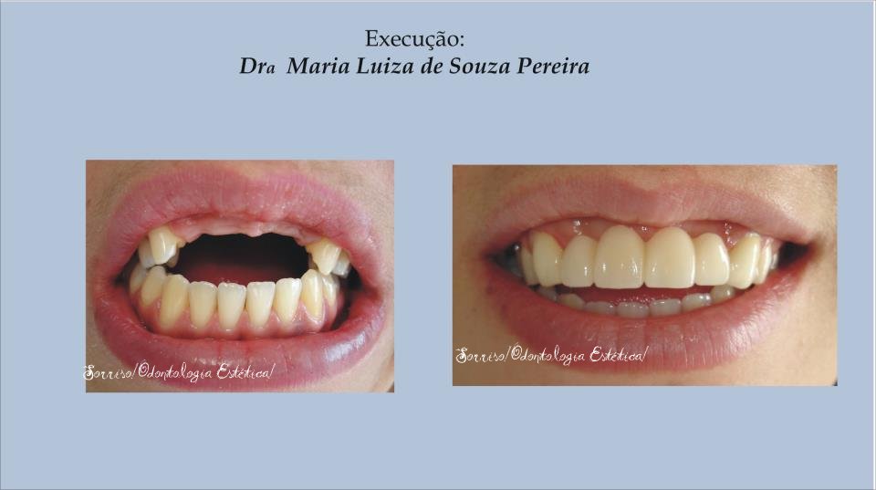 SORRISO! : IMPLANTES OU PONTE FIXA?