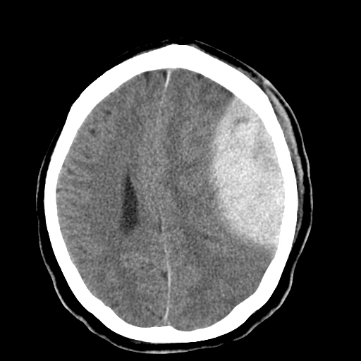 關於外科ICU的一些事: 典型的EDH