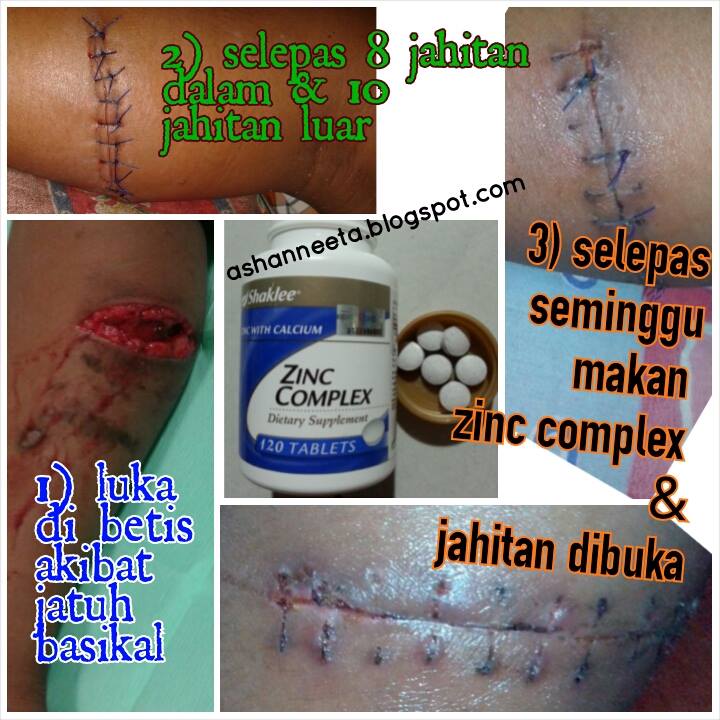 TESTIMONI LUKA JAHITAN SEMBUH SEGERA DENGAN ZINC COMPLEX