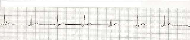 EKG Rhythm Strips 28: Junctional Rhythms