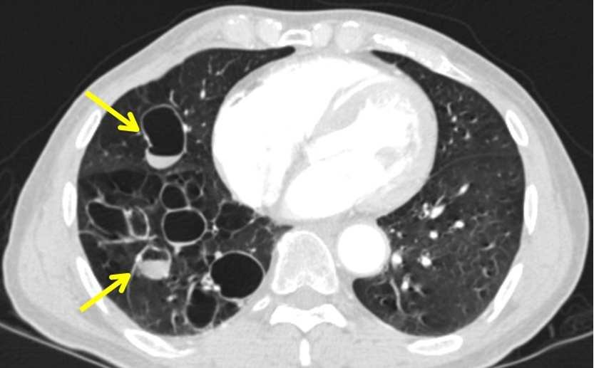 Chest Medicine Made Easy-Dr Deepu: The HRCT findings of Bronchiectasis.