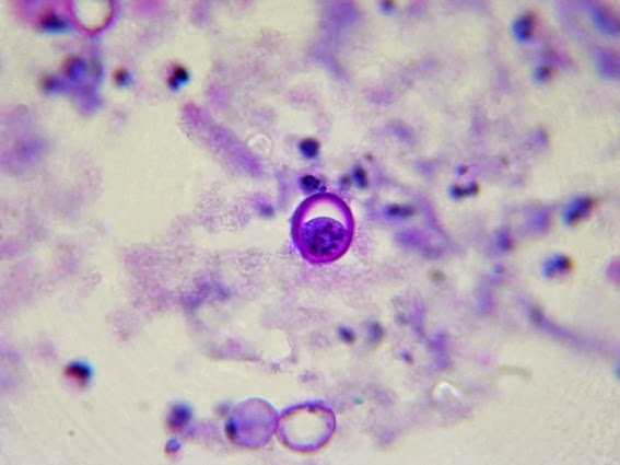 Fun With Microbiology (What's Buggin' You?): Blastomyces dermatitidis