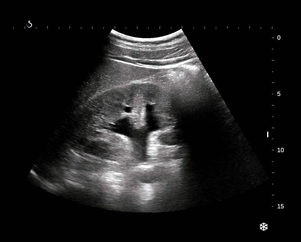 VIETNAMESE MEDIC ULTRASOUND: CASE 432: A K I by STONE, Dr PHAN THANH ...