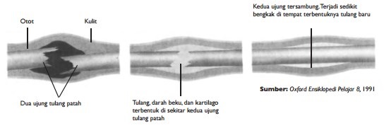 Sains: kelainan pada sistem gerak manusia