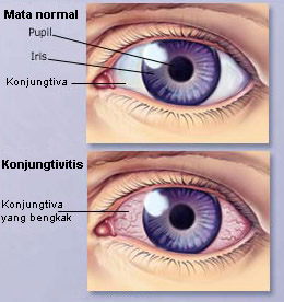 Konjungtivitis - Catatan Mahasiswa FK
