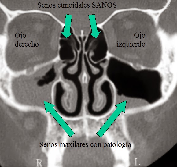 Alteraciones y enfermedades : Sinusitis