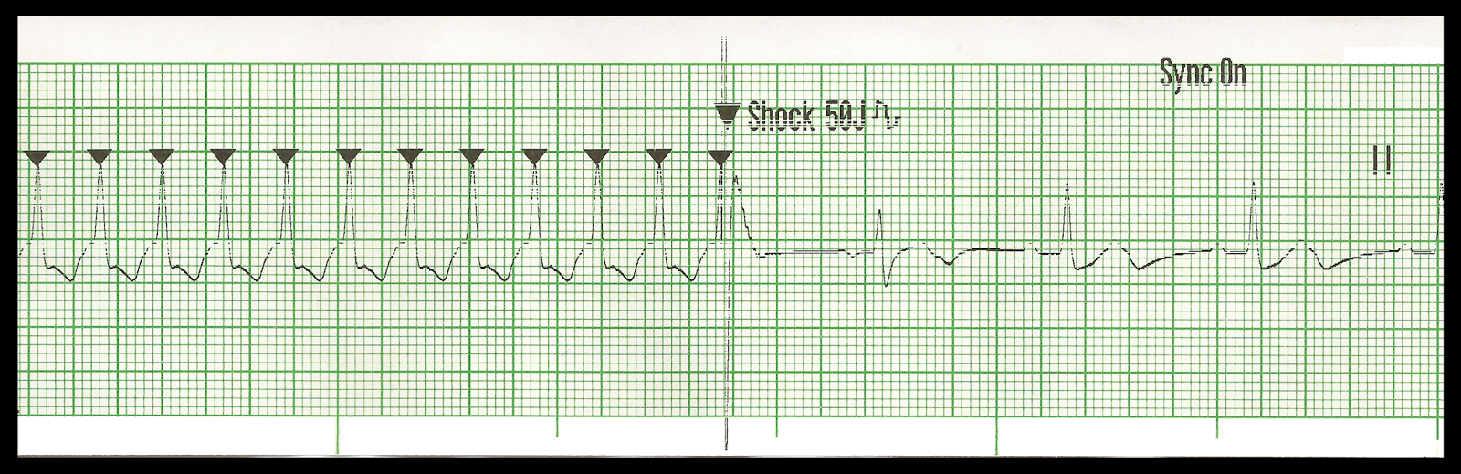 ACLS review: SVT part 6
