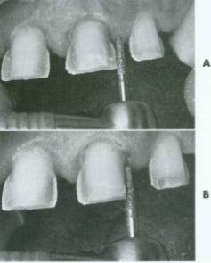 Odontology Student: Prosthodontics: The Metal - Ceramic Crown ...