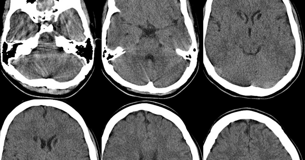 Neuroradiology Cases: MELAS