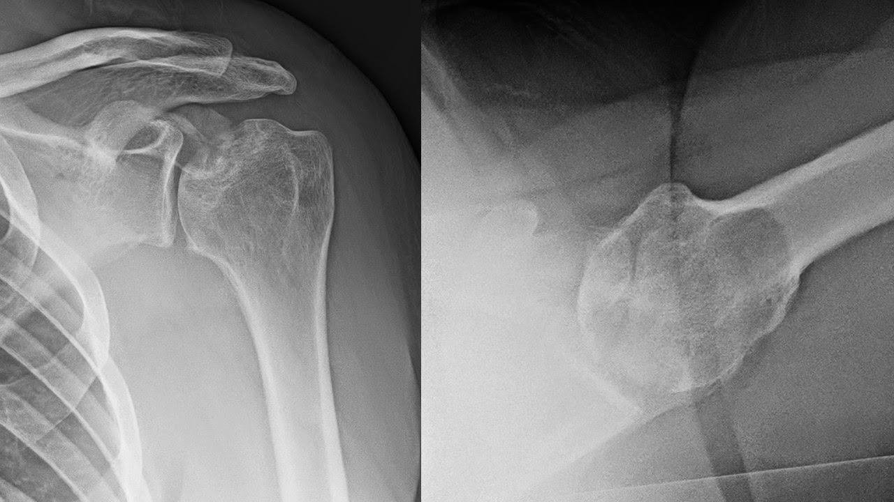 Shoulder and Elbow Surgery: Shoulder resurfacing, hemi-arthroplasty or ...