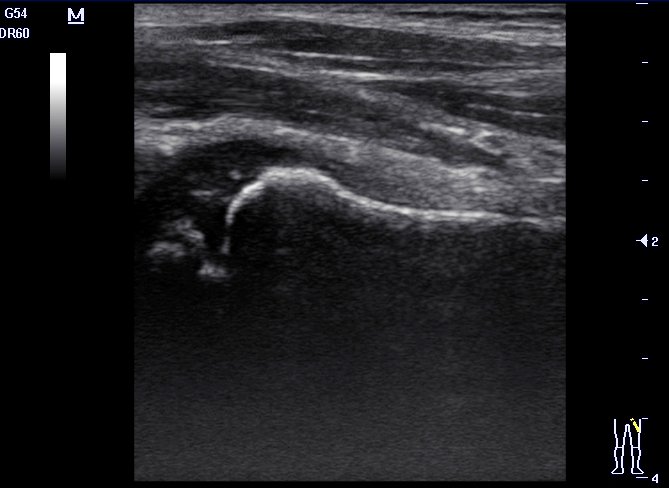 EcoCyl-Msk: Sinovitis transitoria de cadera