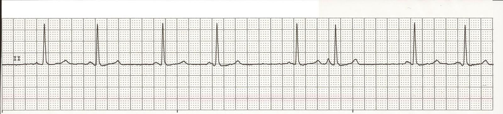 EKG Rhythm Strip Quiz 9