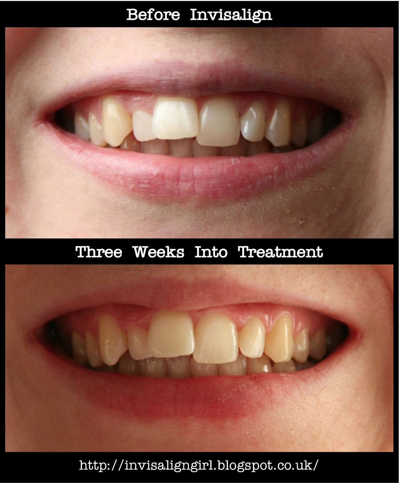 Louise's Invisalign Journey