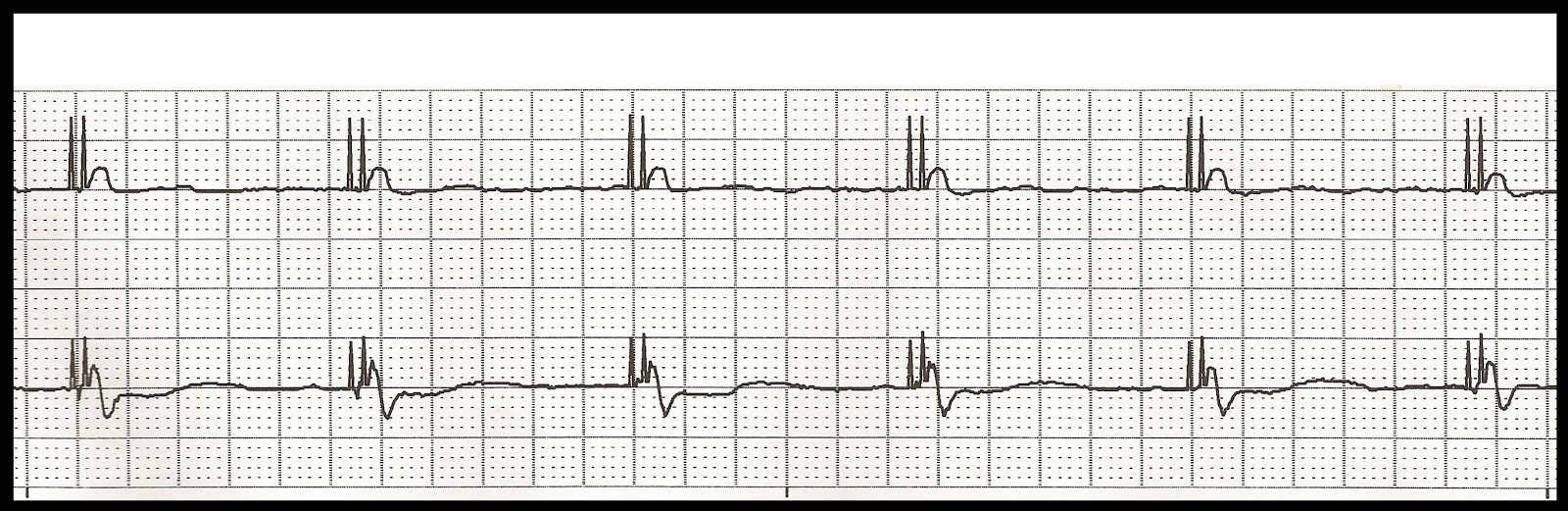 EKG Rhythm Strip Quiz 100: Paced rhythms