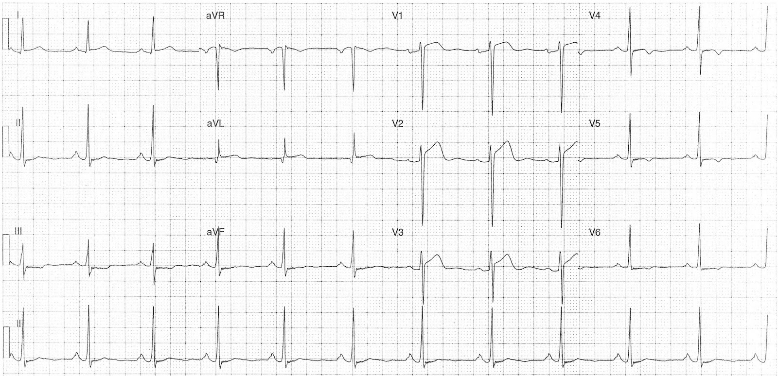 ECG of the Week: ECG of the Week - 21st December 2015 - Interpretation