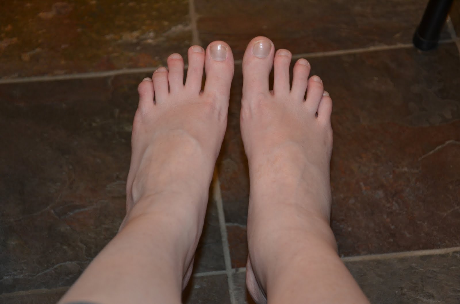 Feet Swollen Like Balloons at Emil Bentley blog