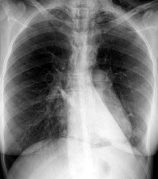 RADIOLOGY IMAGE SPOTTERS: Left lower collapse + pneumo