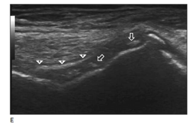 BÀI SOẠN VỀ SIÊU ÂM CHẨN ĐOÁN: DẤU VIỀN BA (TRIPLE CONTOUR SIGN) Ở ...