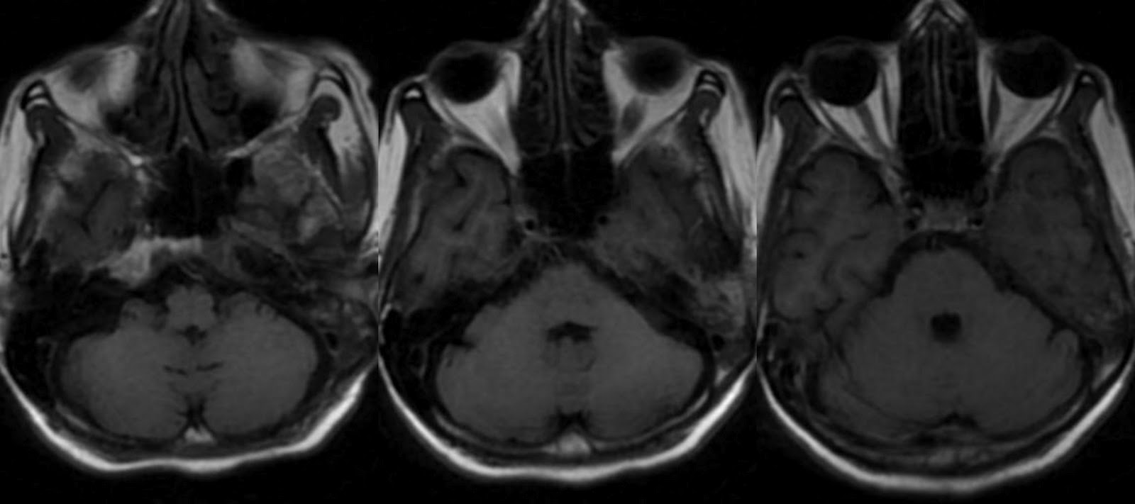 Dr Balaji Anvekar FRCR: Gradenigo's syndrome MRI