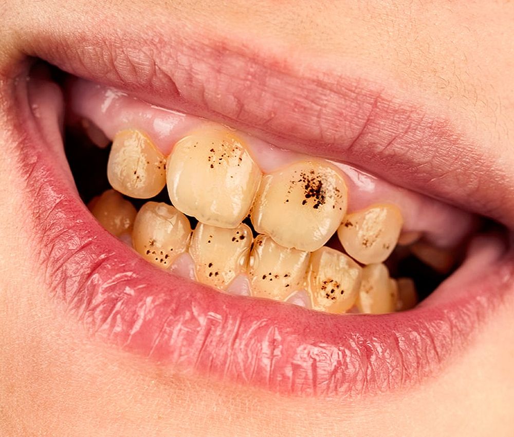 CLINICA MIMA: PIGMENTACIONES DENTALES