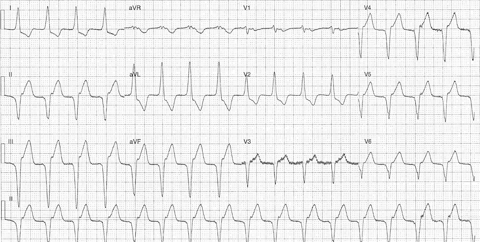 ECG of the Week: ECG of the Week - 28th March 2016 - Interpretation