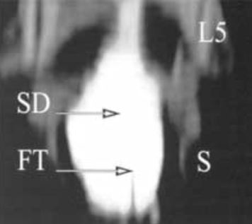 Por los caminos de la osteopatía: LA FORCE DE TRACTION MÉDULLAIRE