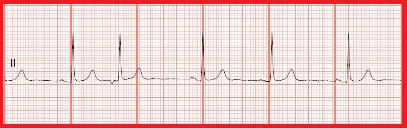 Practice EKG Rhythm Strips 200