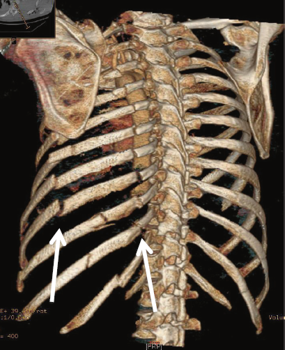 Revision Casos De Cirugia General: TORAX INESTABLE O TORAX FLOTANTE: