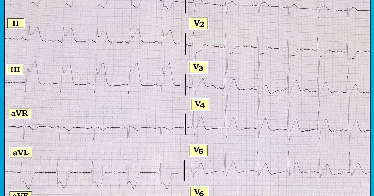 ECG Interpretation: ECG Blog #141 (Anatomy - Lat - Post - Inf - MI)