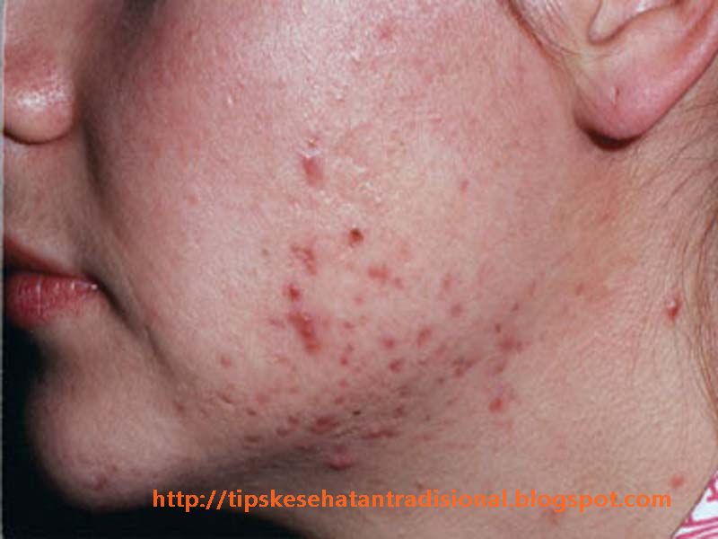 Jenis Jerawat Papule adalah jenis jerawat