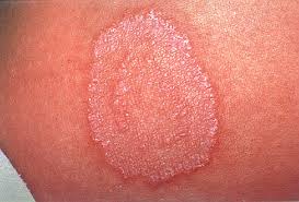 Ringworm infection