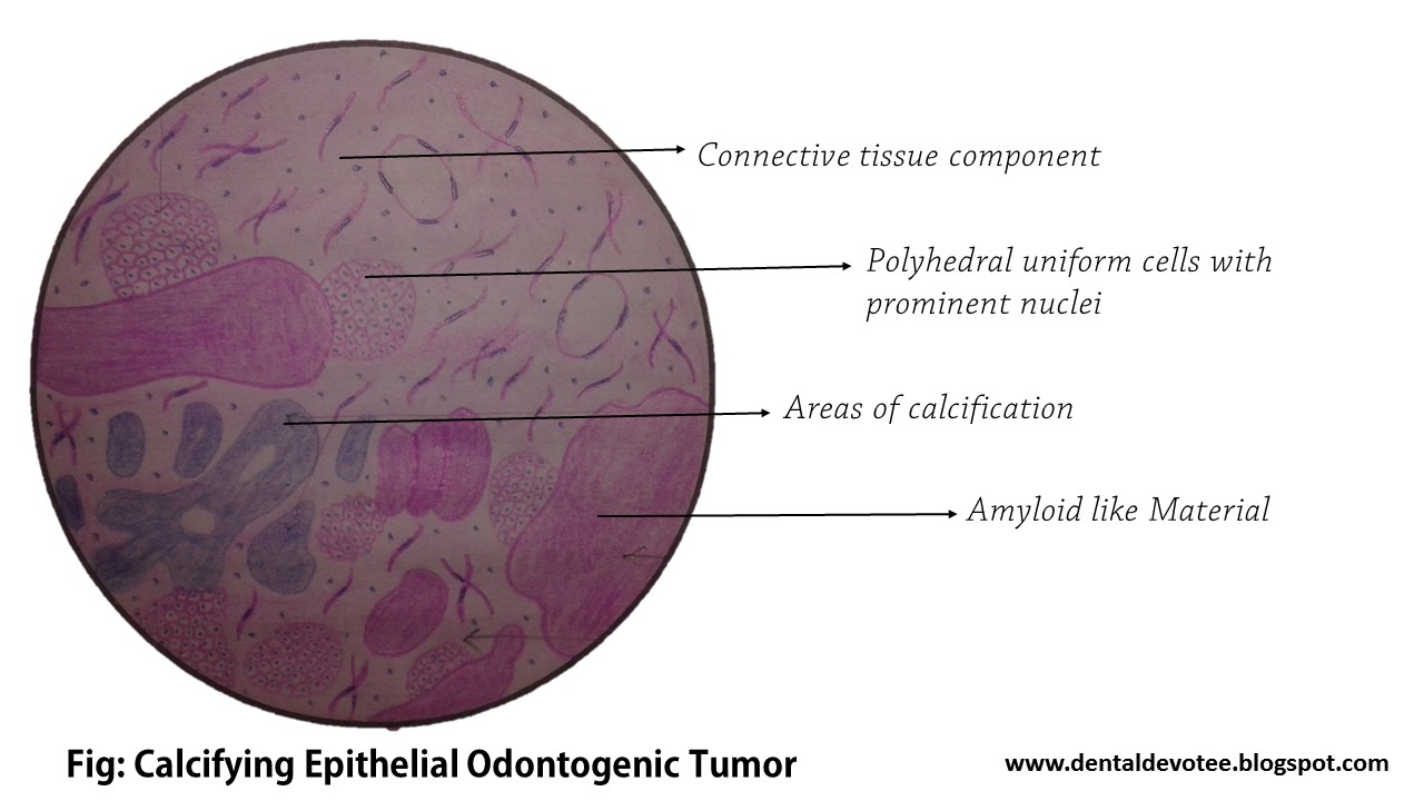 Calcifying Odontogenic Cyst Histology