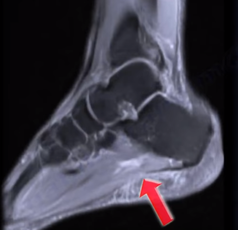 Dr. Nabil Ebraheim's Blogspot: Rupture of the Plantar Fascia