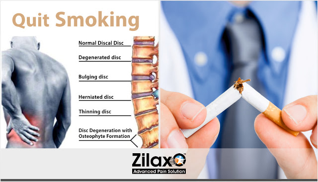 Zilaxo Advanced Pain Solution: Quit Smoking To Reduce The Risk Of Back ...