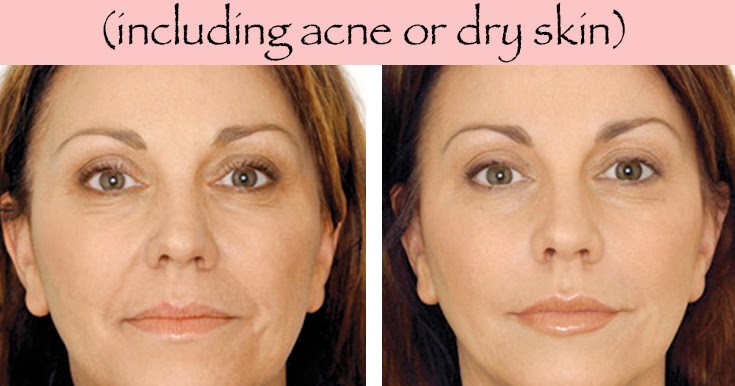 Natural botox: Homemade banana mask against wrinkles (including acne or ...