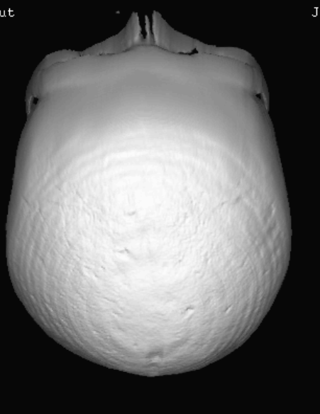 Oxycephaly-CT - Sumer's Radiology Blog