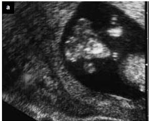 MedFriendly Medical Blog: The Mickey Mouse Sign in Medicine: part 3