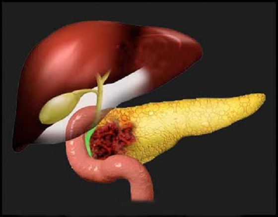 AJORBAHMAN'S COLLECTION: What is Pancreatic Cancer & What are the Risk ...